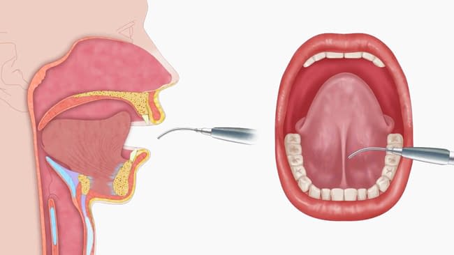 Laser Frenectomy | Dr. Edward C. Yates