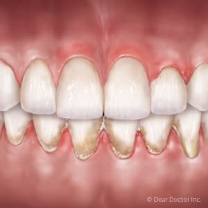Your Gum Tissue 'Biotype' Could Determine How Gum Disease Affects You ...