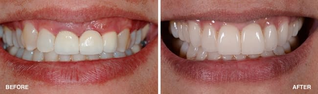 Cosmetic Laser Gum Surgery | Dr. Edward C. Yates